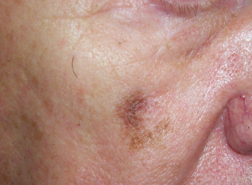 Clinical Challenge: Growing Brown Lesion on Cheek - Healthcare ...