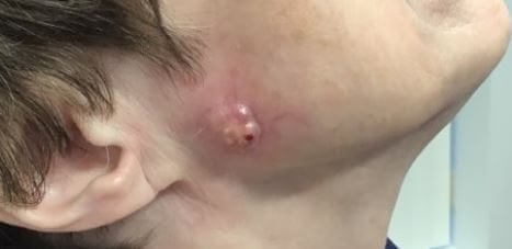 Clinical Challenge: Flesh-Colored Nodule on Cheek - Healthcare ...